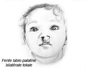 Fentes Bilatérales - Chirurgie Plastique Pédiatrique Montpellier