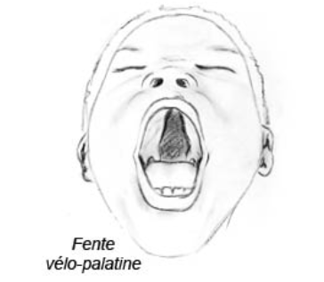 Fentes Vélo-Palatines - Chirurgie Plastique Pédiatrique Montpellier