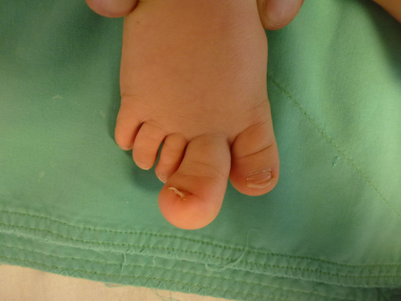 Malformations des Mains et des Pieds - Chirurgie Plastique Pédiatrique