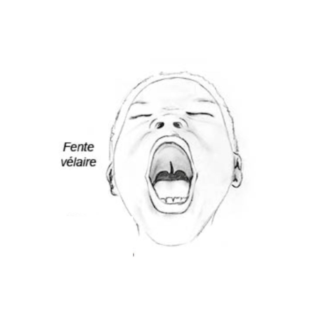 Fentes Vélo-Palatines - Chirurgie Plastique Pédiatrique Montpellier