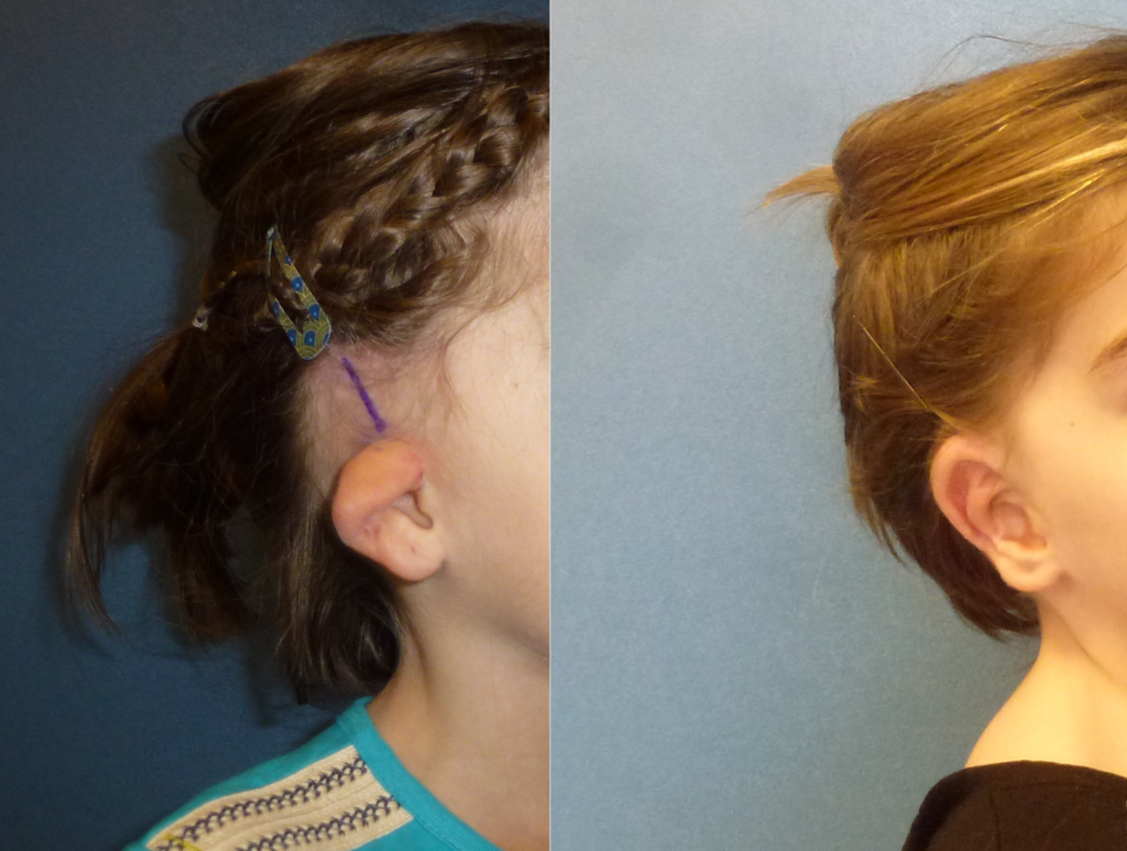 Chirurgie des Oreilles - Chirurgie Plastique Pédiatrique Montpellier
