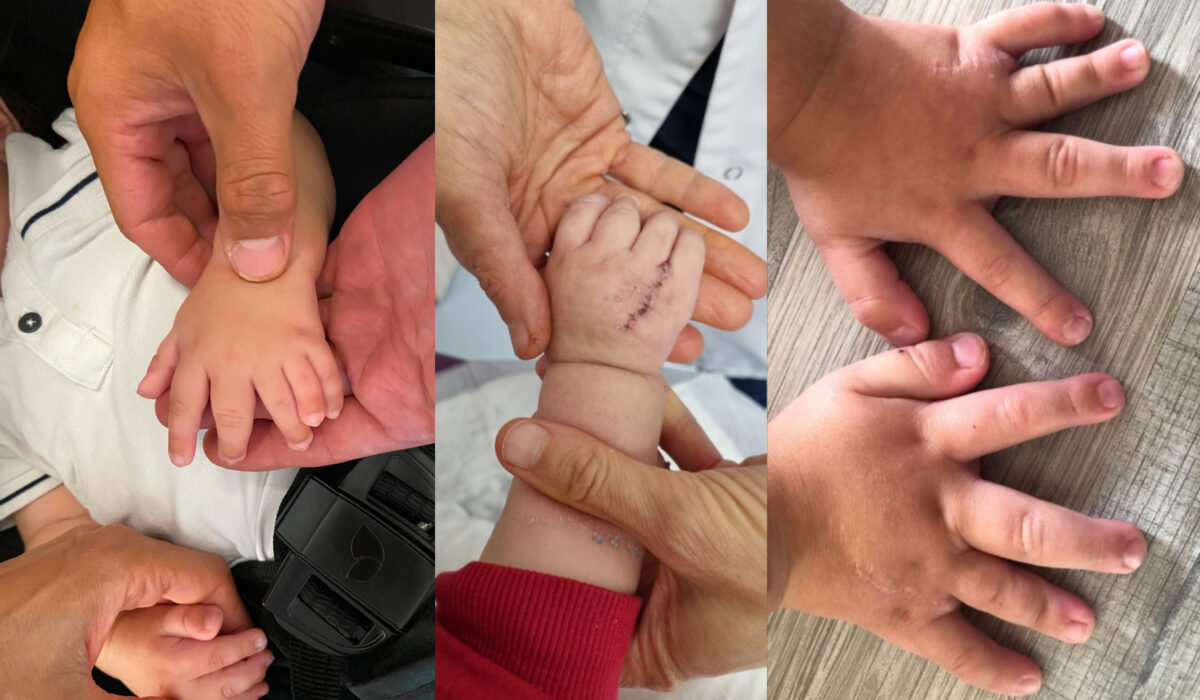 Malformations des Mains et des Pieds - Chirurgie Plastique Pédiatrique