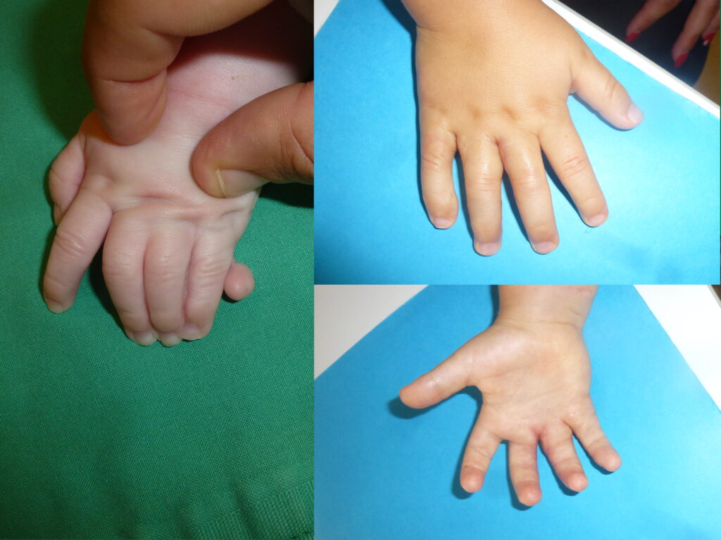 Malformations des Mains et des Pieds - Chirurgie Plastique Pédiatrique